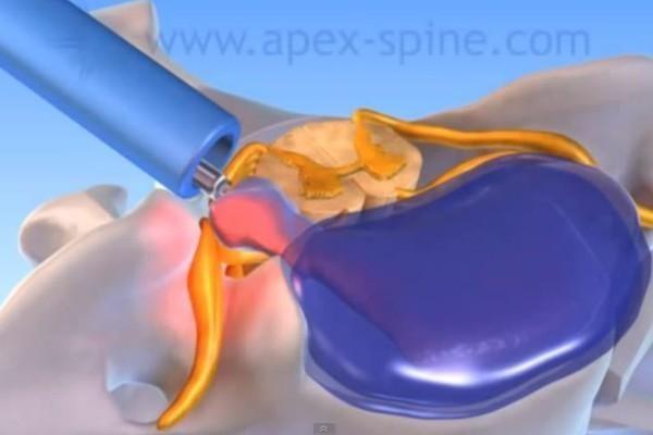 Microforaminotomy - APEX Spine 2023