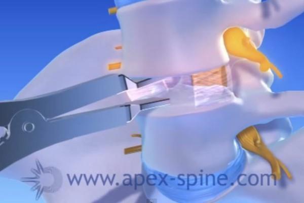 Lumbar spine - APEX Spine 2023